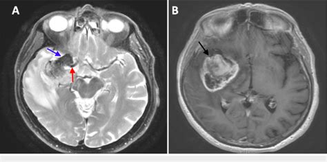 Magnetic Resonance Imaging Mri Of Patients Brain A Axial T2 Mri