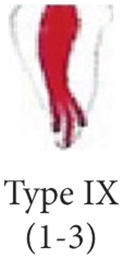 Vertuccis Classification Of Root Canal Morphology From Type I To Type