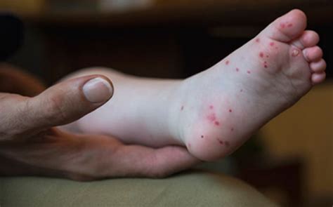 Qué Es El Virus Coxsackie Y Cómo Prevenirlo Grupo Milenio
