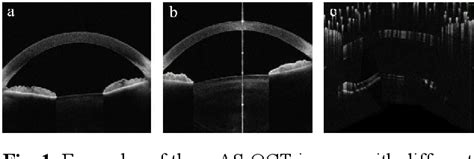 Figure 1 From Automated Image Quality Assessment For Anterior Segment Optical Coherence