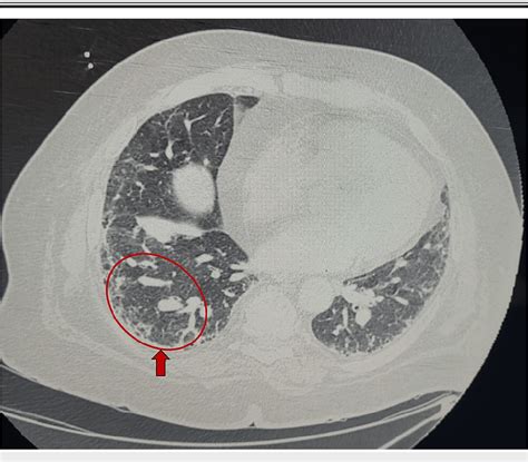 Figure 2 From Thoracic Segmental Spinal Anesthesia For Emergency Cholecystectomy A Case Report