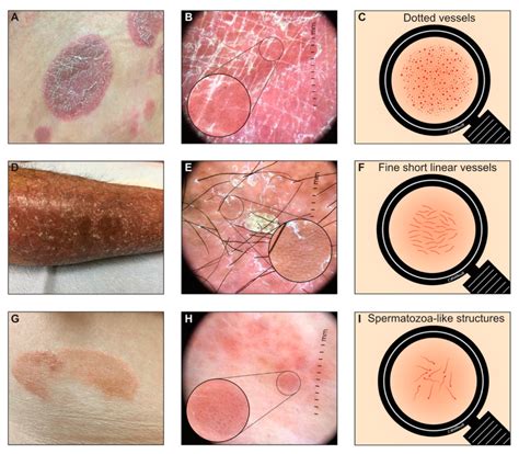 Ai Vascular Patterns Dermoscopic Features Of Vascular Patterns