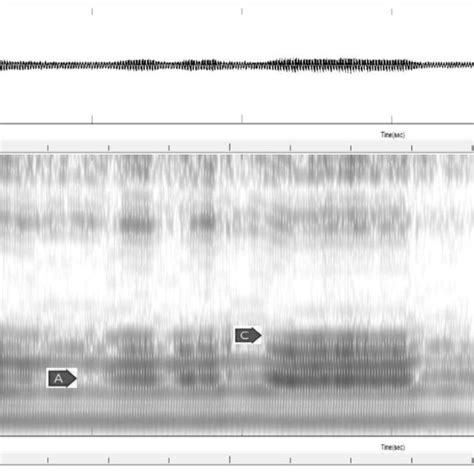 Representative Spectrogram From An Adsd Subject Abrupt Voice Break A