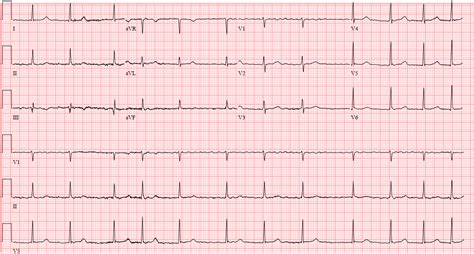 Post Op Atrial Fibrillation — When The Beat Drops A Residents Guide