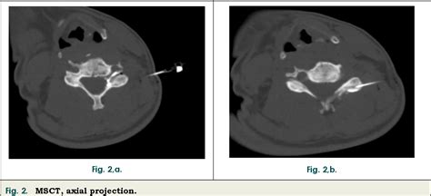 Figure 2 From Ct Guided Cervical Nerve Root Injections As A Treatment