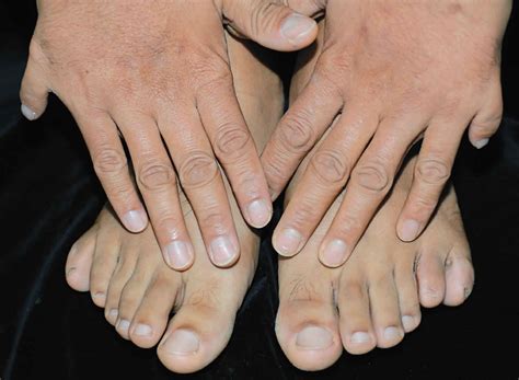 30 Facts About Polydactyly Postaxial