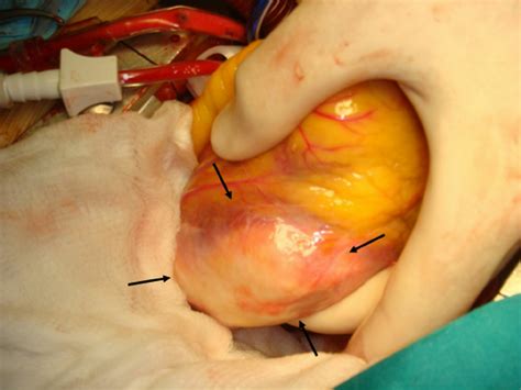 Echinococcus Cyst During Operation The Black Arrows Depict The Cyst Download Scientific
