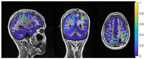 Eeg Brain Scan Results