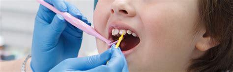 Fluoride Treatment For Sensitive Teeth A Soothing Solution