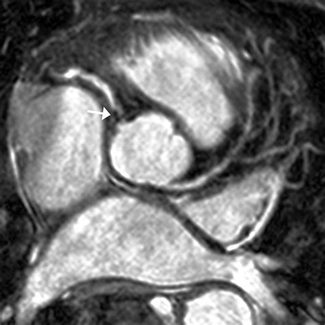 Comparison Of 3d Segmented Gradient Echo And Steady State Free