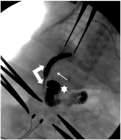 Cholangiography Depicting Filling Of The Gallbladder With Emptying Via