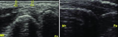 Ultrasound Detected Synovitis In Metacarpophalangeal Joints A Download Scientific Diagram
