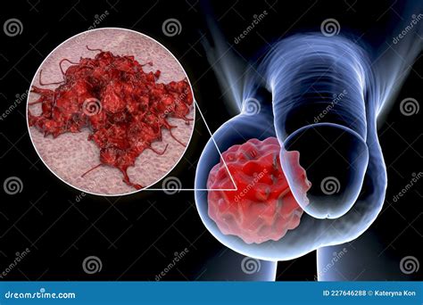 Testicular Cancer 3d Illustration Stock Illustration Illustration Of
