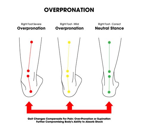 Correcting Over Pronation Z Coil Pain Relief Footwear
