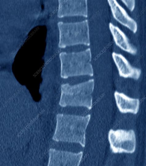 Thoracic Spine Fracture Ct Scan Stock Image C0528798 Science