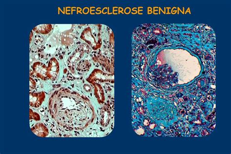 Ppt Nefroesclerose Powerpoint Presentation Free Download Id3549641