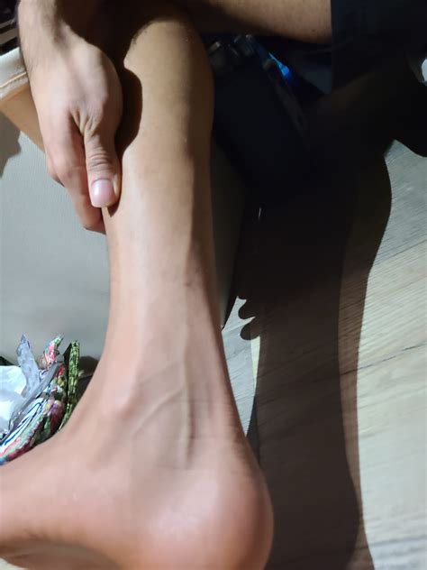 Bulging Veins Reactions R Dysautonomia