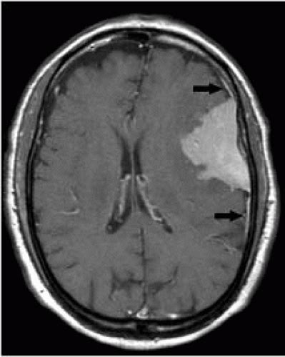 Extra Axial Masses Radiology Key