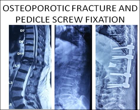 Pedicle Screw Fracture Pedicle Screw Fracture Detection And