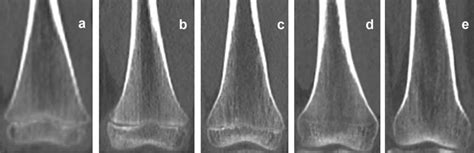 The Process Of Distal Femoral Epiphyseal Fusion Based On Mckern And Download Scientific