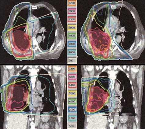 Comparison Of Radiation Isodose Distribution With Three Dimensional