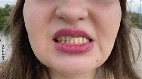 Patient With Dislocated Jaw And Malocclusion Temporomandibular Joint Dysfunction She Is