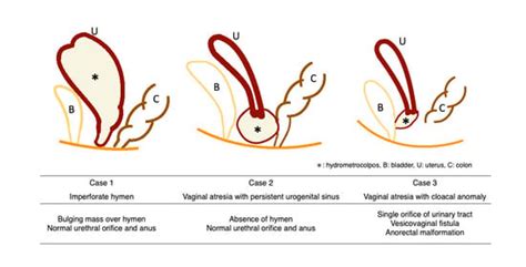 Pediatric Imperforate Hymen