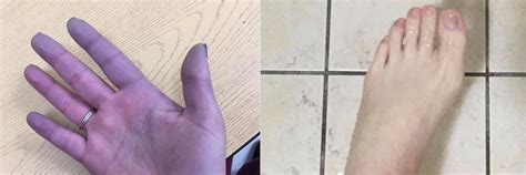 15 Photos That Show What It Looks Like To Live With Raynauds Syndrome