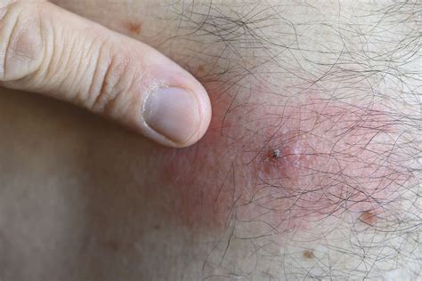 Tick Bite Pictures Symptoms When To Be Concerned