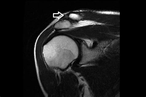 Shoulder Mri Without Contrast