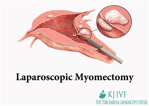 Laparoscopic Myomectomy Treatment In Delhi Faridabad India