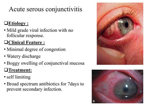 Viral Conjunctivitis Pptx