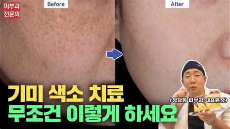 기미 치료 아직도 레이저 토닝 받으세요 진짜 기미치료법 알려드립니다 Youtube