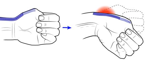 De Quervain Tenosynovitis Total Orthopaedic Care And Surgery