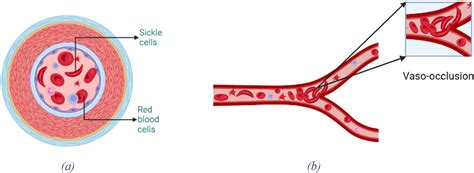 Figure 1 From Detection Of Sickle Cell Disease Using Deep Neural Networks And Explainable