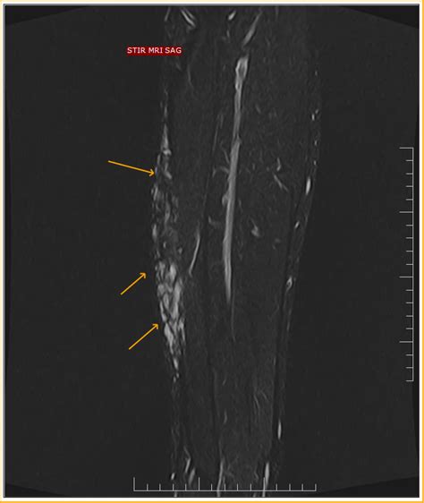 Adamantinoma Tibia Cross Sectional Imaging Sumers Radiology Blog
