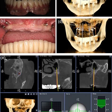 Clinical Procedure For Static Computer Aided Implant Surgery S Cais Download Scientific