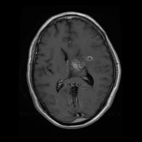 Brain Mri Image Object Detection Dataset And Pre Trained Model By Mri Image