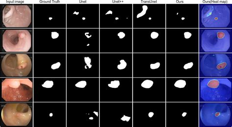 Multi‐scale Nested Unet With Transformer For Colorectal Polyp Segmentation Wang 2024