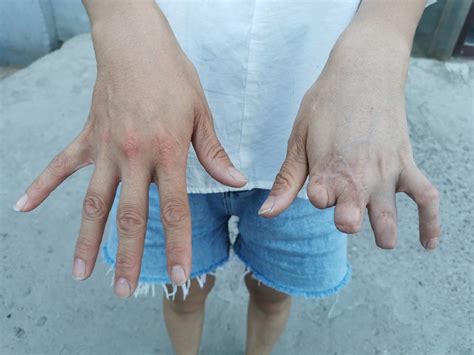 【官网】安装假肢 首选呼市假肢公司 呼和浩特市品硕假肢矫形器有限公司 内蒙假肢指定装配中心