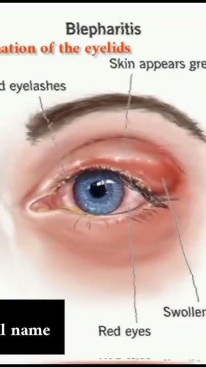 Blepharitis Viral Video Foryoupage Optometrist Youtube