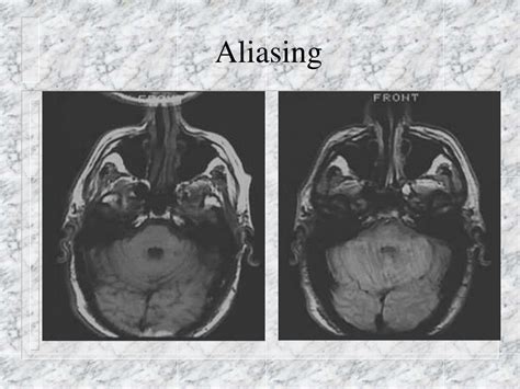 Ppt Mri Artifacts Powerpoint Presentation Free Download Id5323805