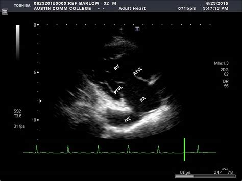 Parasternal Window Sonography Resources