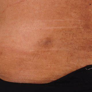 A 1 5 Cm Very Hard Non Tender Subcutaneous Nodule With Overlying Download Scientific Diagram