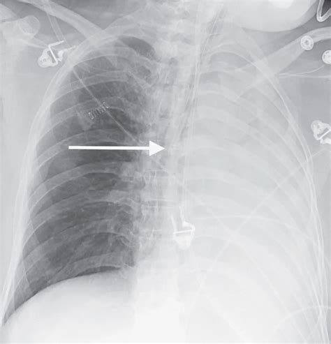 Normal Vs Abnormal Chest X Rays What Do They Reveal