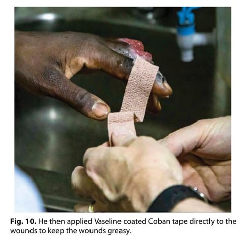 Five Months Of Basic Wound Care Heal The Wounds With Exposed Bone On A