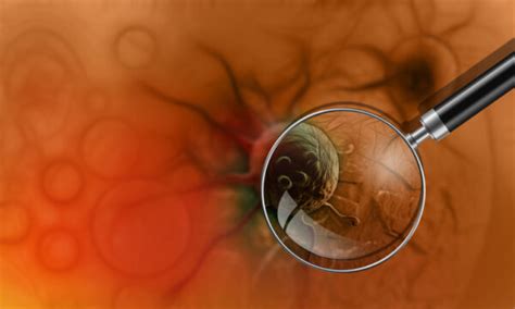 Pilonidal Cyst Surgery Video Pilonidal Expert