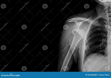 Fracture Proximal Humerus Arm In Osteopenia Patient Elderly Broken Bone Stock Photography
