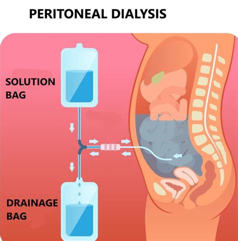 Dialysis In India