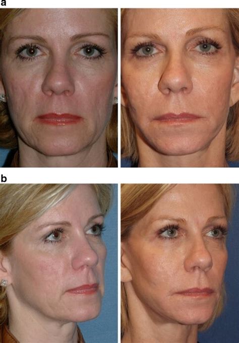 A An Example Of A 50 60 Year Old Patient With High Lean Body Mass And
